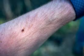 La peligrosa garrapata que puede provocar alergia a la carne preocupa a ...